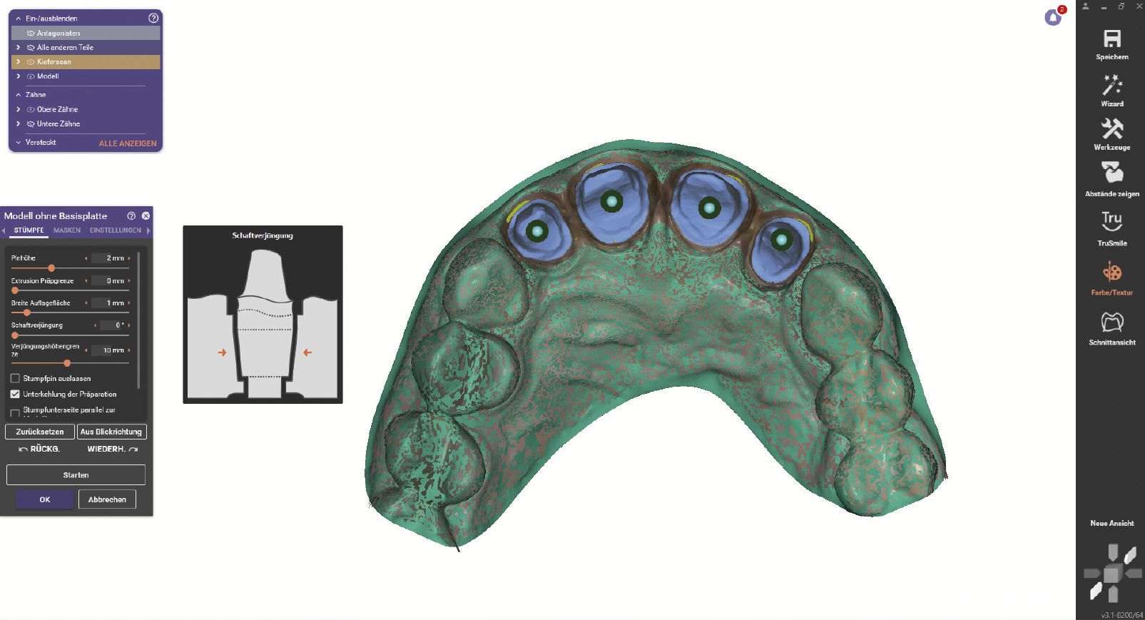 FINO DENTALART (powered by exocad) – Model Creator Modul | kurs005